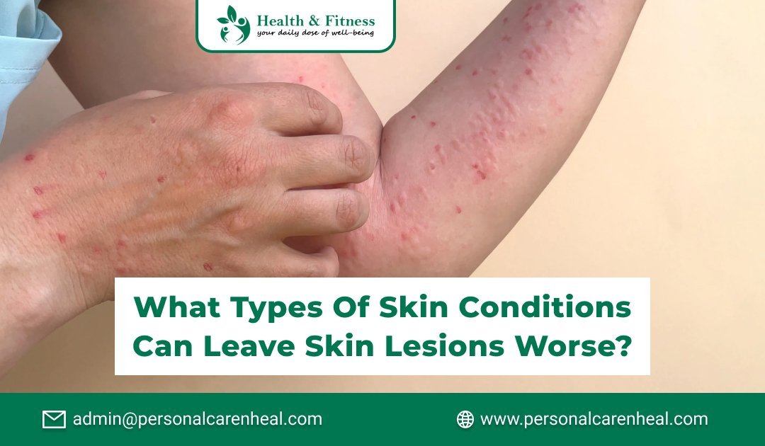 What Types of Skin Conditions Can Leave Skin Lesions Worse?