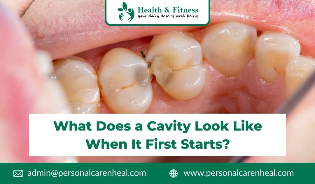 What Does a Cavity Look Like When It Forms?
